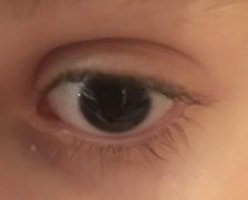 About Aniridia - Aniridia North America