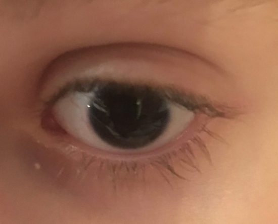 About Aniridia - Aniridia North America